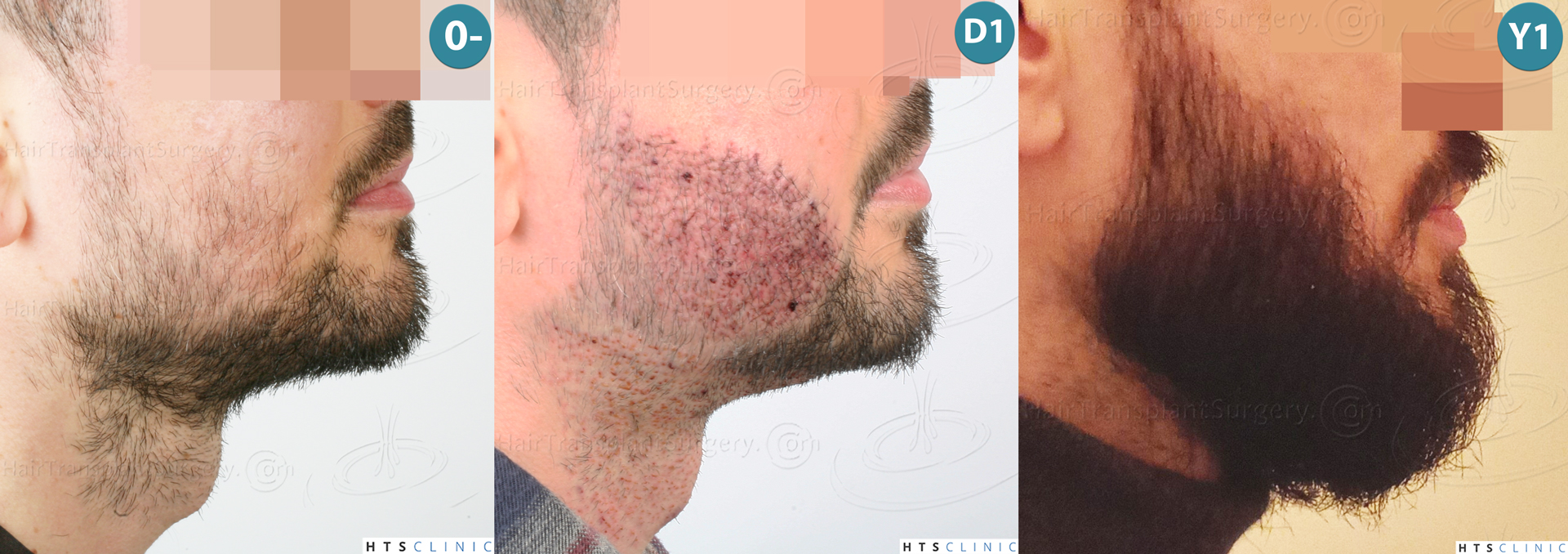 Dr Jean Devroye Hts Clinic 1523 Fue Beard To Beard Restoration